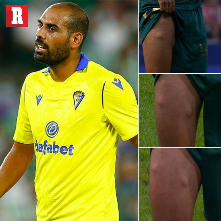 Fali: La impactante lesión que ocurrió en el Atlético de Madrid vs Cádiz