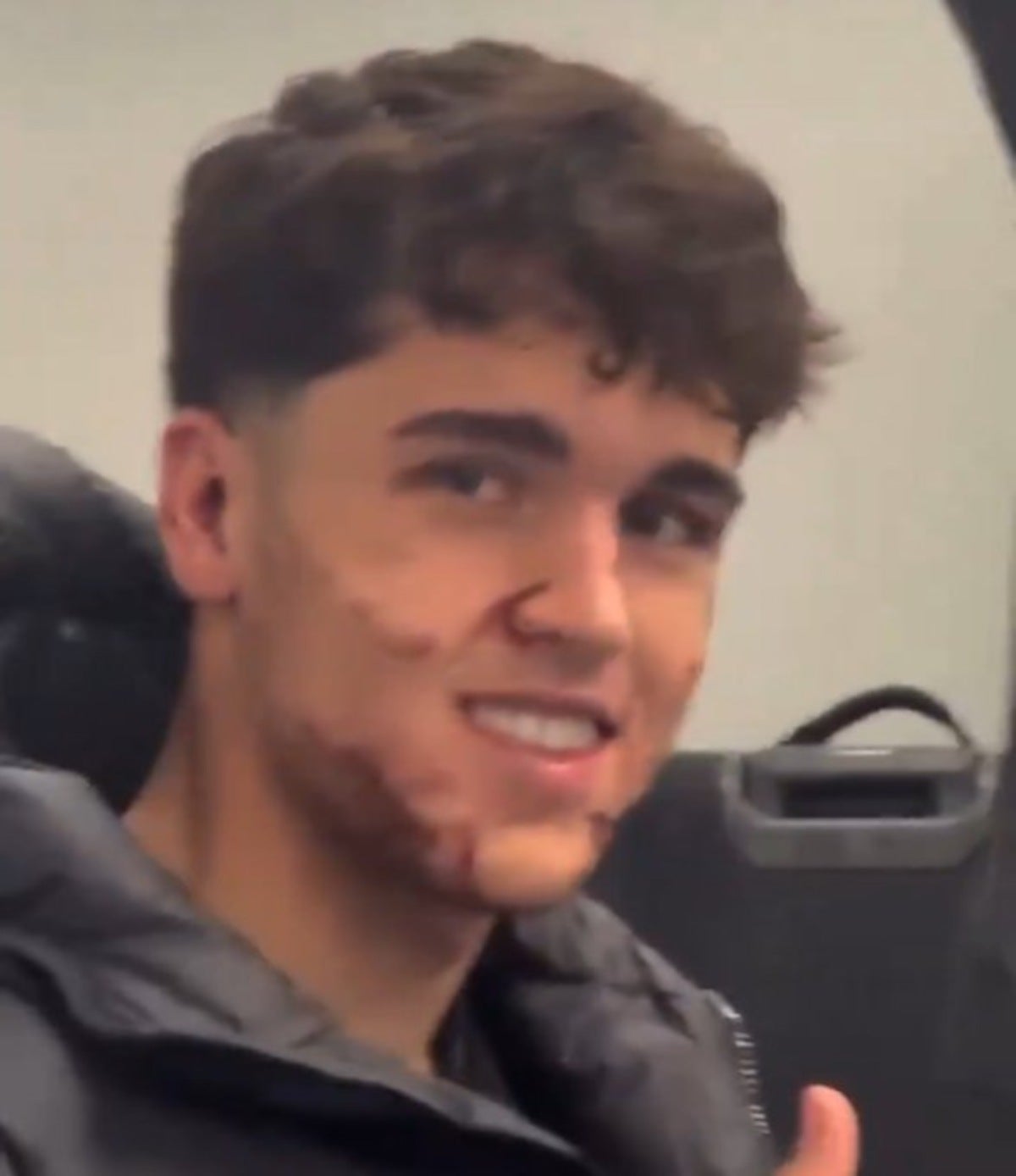 Así quedó el rostro de Cubarsí tras patada que recibió ante Estrella Roja