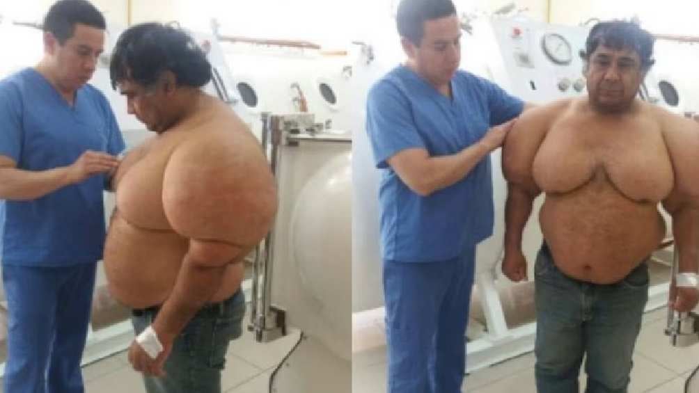 Conoce el caso de Alejandro Ramos, el buzo peruano que vive con el cuerpo 'inflado'